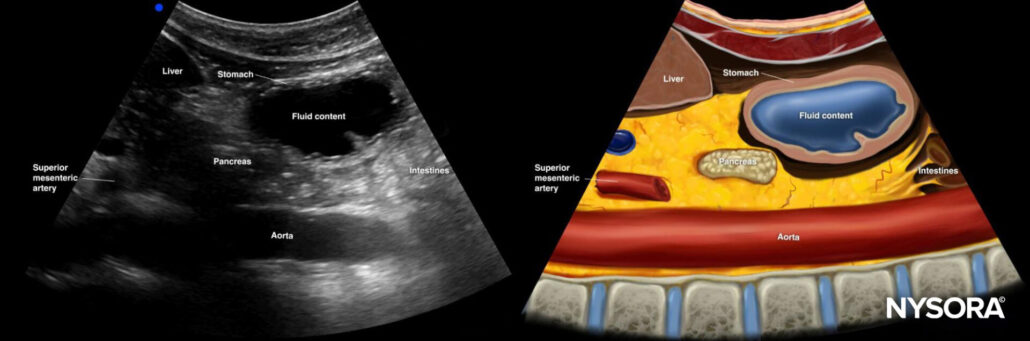 Alert: every anesthesiologist should master gastric ultrasound - NYSORA