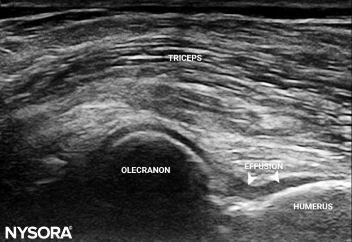 Golfer’s Elbow (Medial Epicondylitis) and Steroid Injection Treatment ...