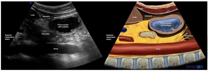 Mastery of gastric ultrasound - Identifying intraluminal fluid content ...