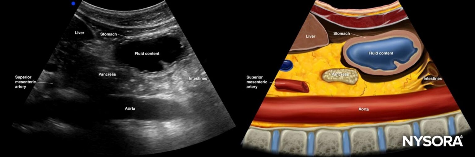 Mastery of gastric ultrasound - Identifying intraluminal fluid content ...