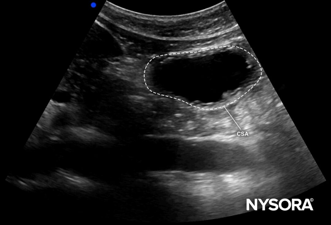 Mastery of gastric ultrasound - Identifying intraluminal fluid content ...