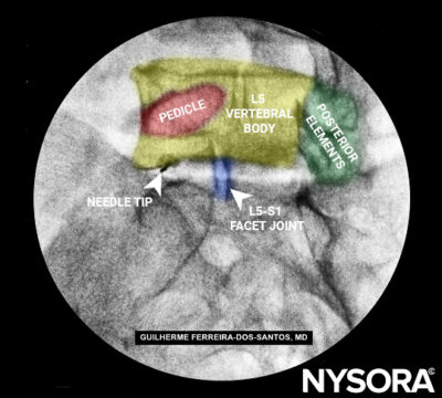 Case study: Cancer-related lower abdominal and pelvic pain - NYSORA