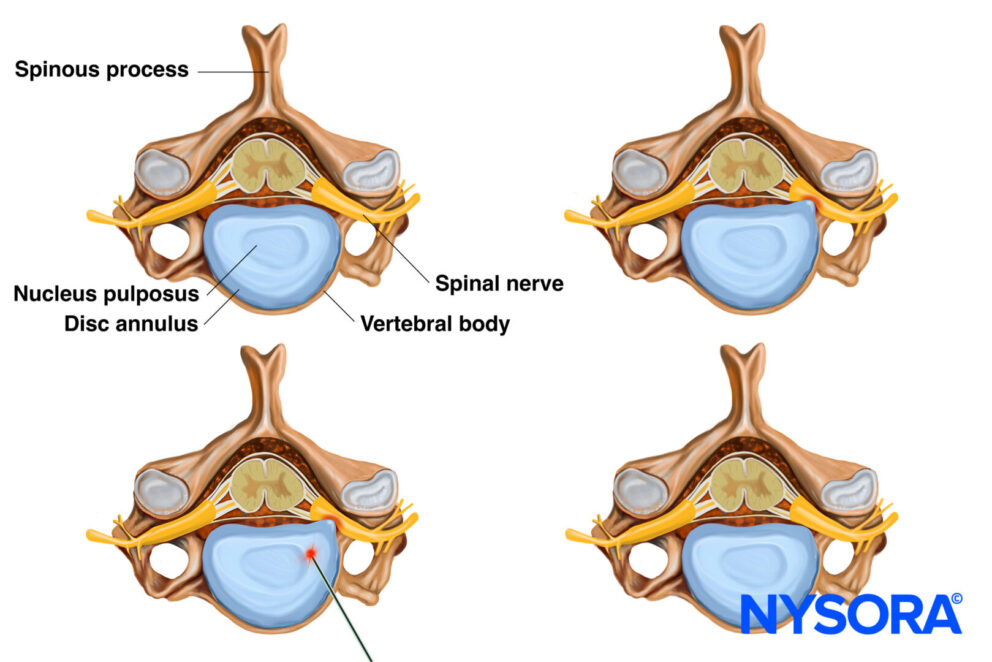 Case Study: Cervical Hernia with Radicular Pain - NYSORA