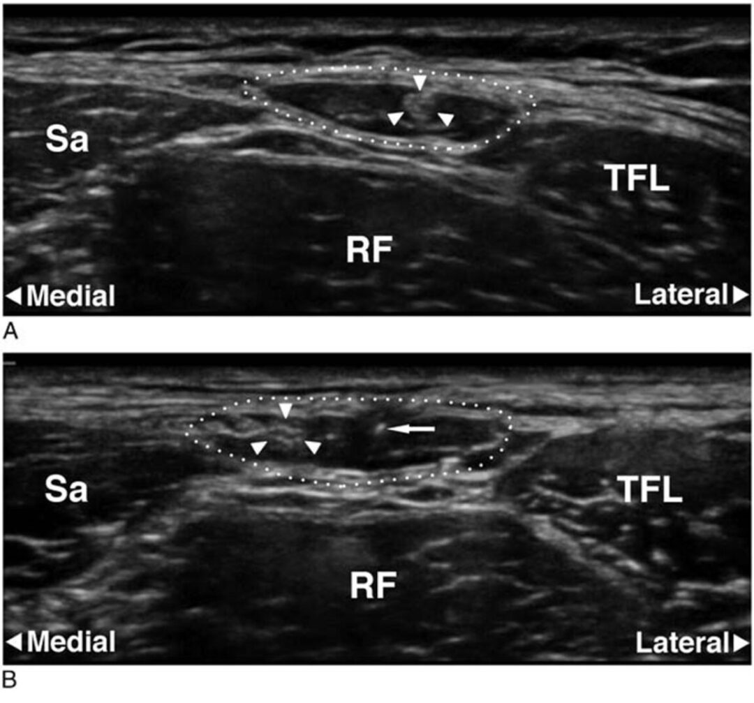 Tips for a Lateral Femoral Cutaneous Nerve Block - NYSORA