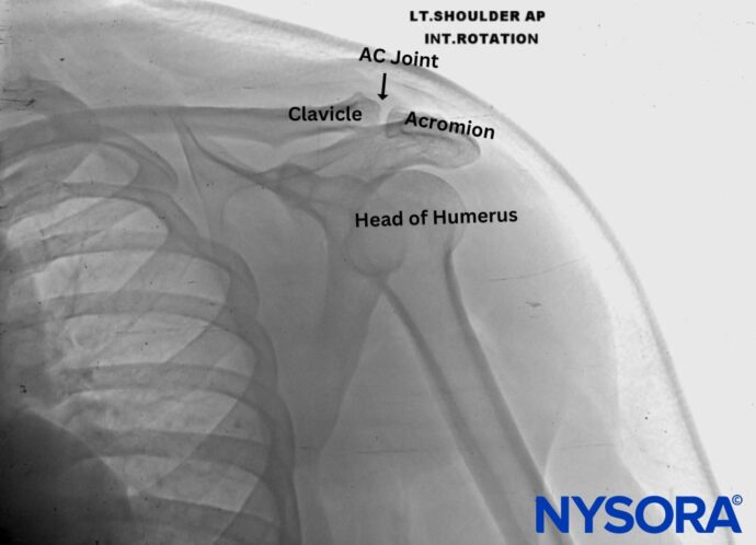Case study: Acromioclavicular joint arthritis - Injection - NYSORA