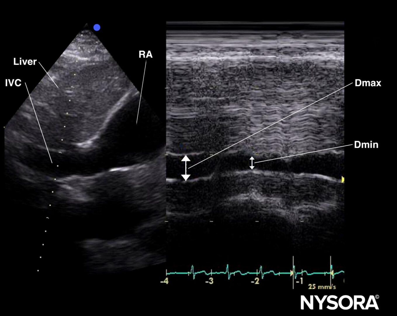 Assessing Fluid Status in the ICU: The Role of POCUS - NYSORA