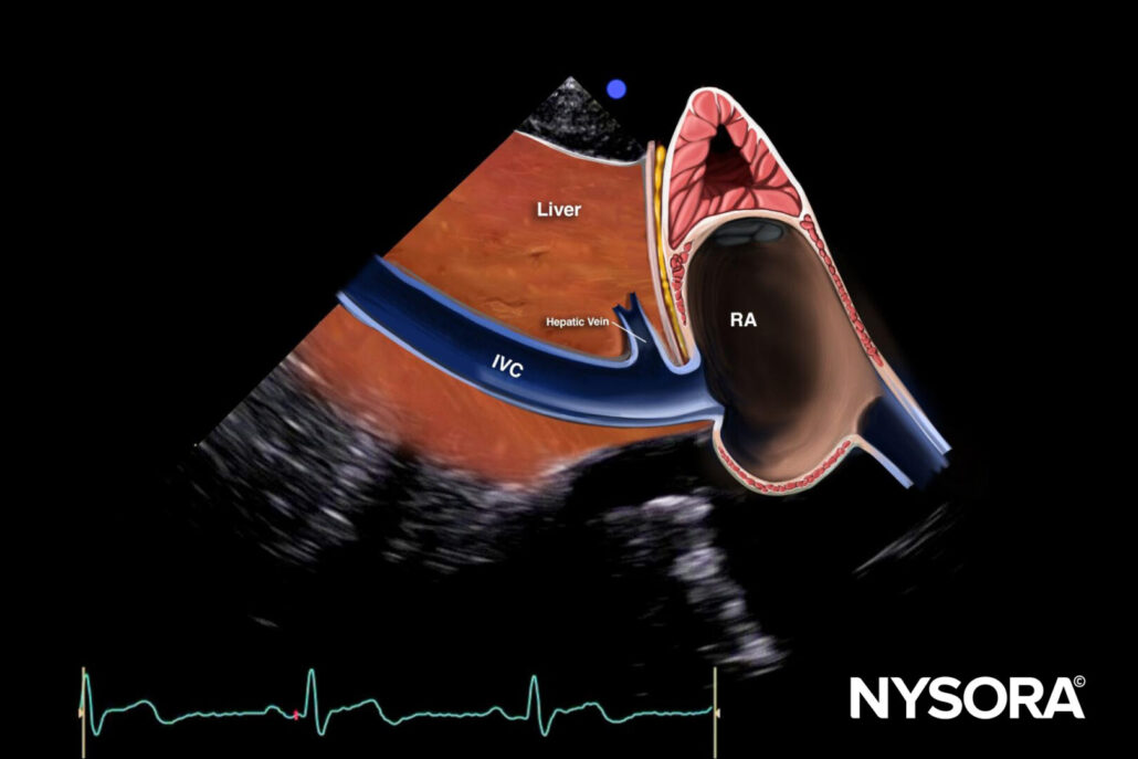 Assessing Fluid Status in the ICU: The Role of POCUS - NYSORA