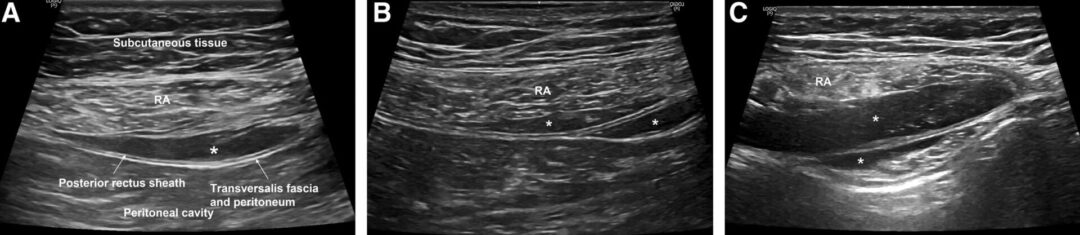 Mastering the Ultrasound-Guided Rectus Sheath Block - NYSORA
