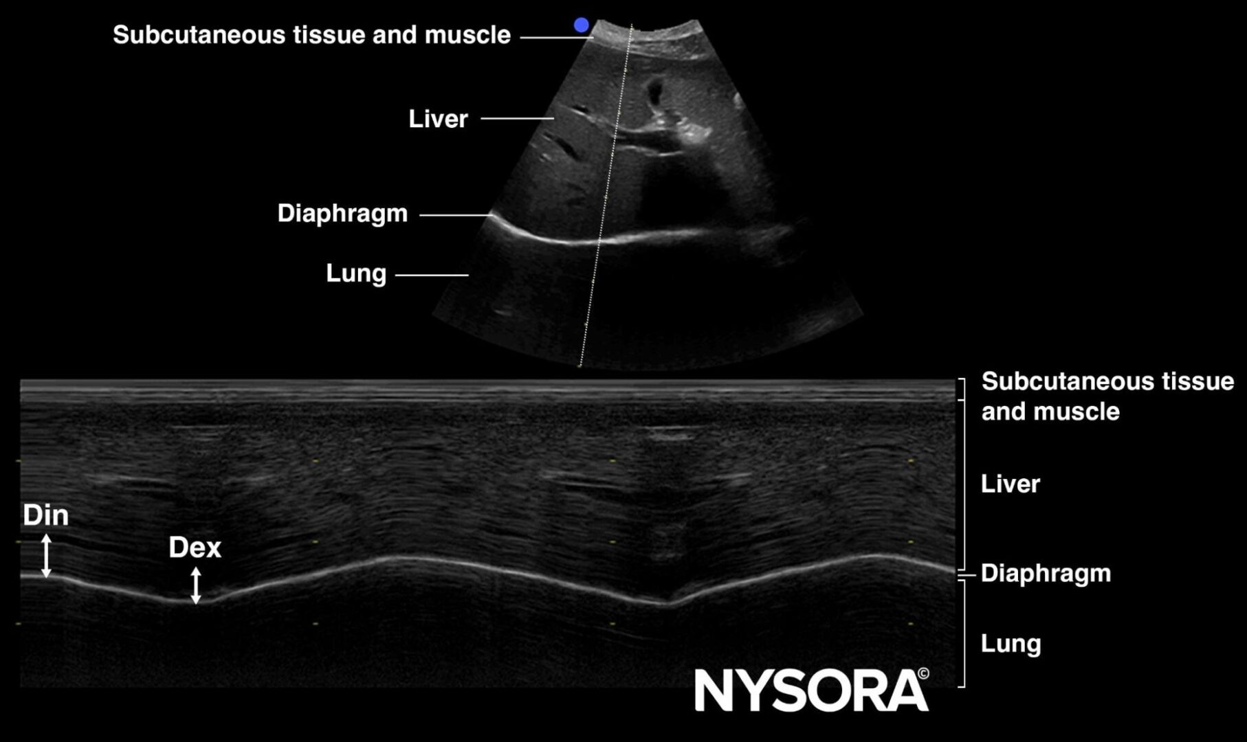 Case study: Monitoring phrenic nerve paresis with POCUS after regional ...