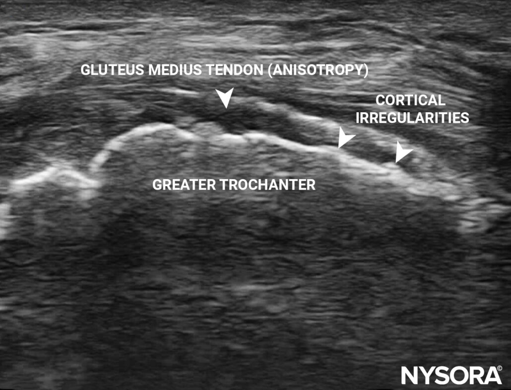 Case study: Greater trochanteric pain syndrome - Injection - NYSORA