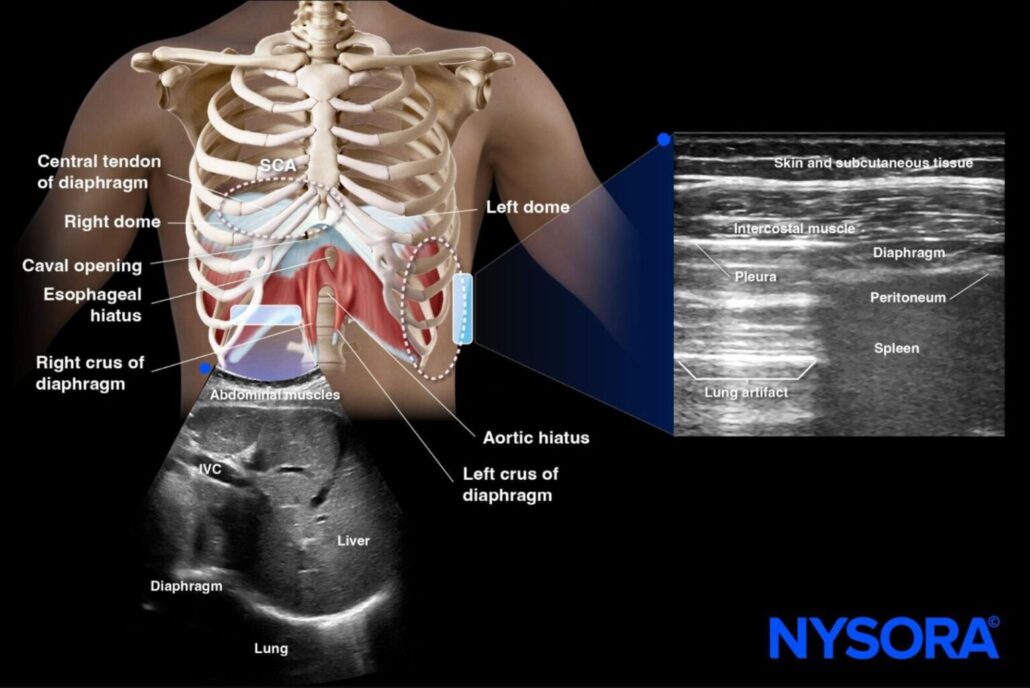 Case study: Monitoring phrenic nerve paresis with POCUS after regional ...