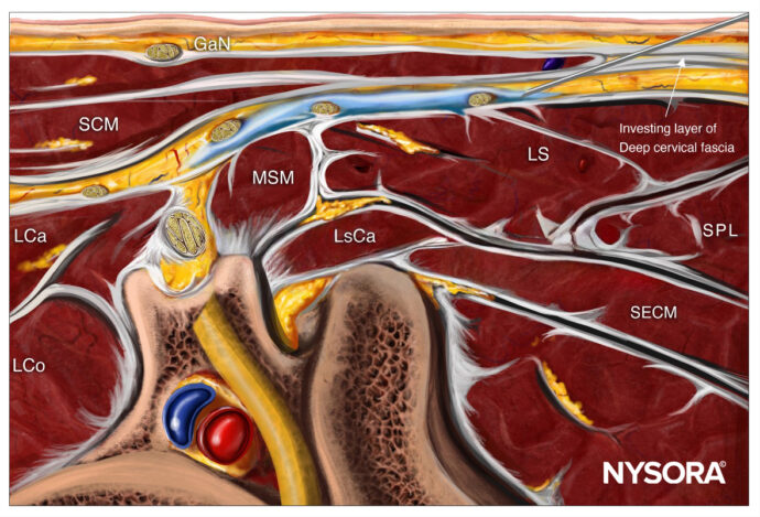 Case study: Carotid endarterectomy completed under a cervical plexus ...