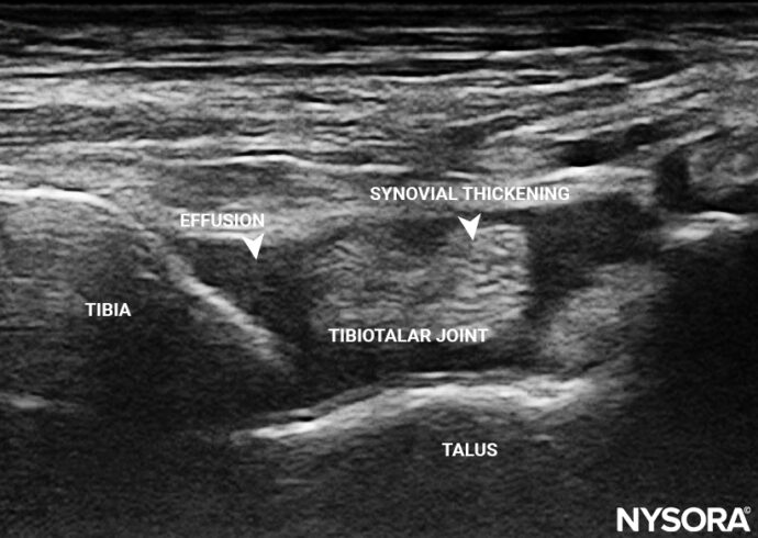 Case study: Ankle joint effusion - Injection - NYSORA