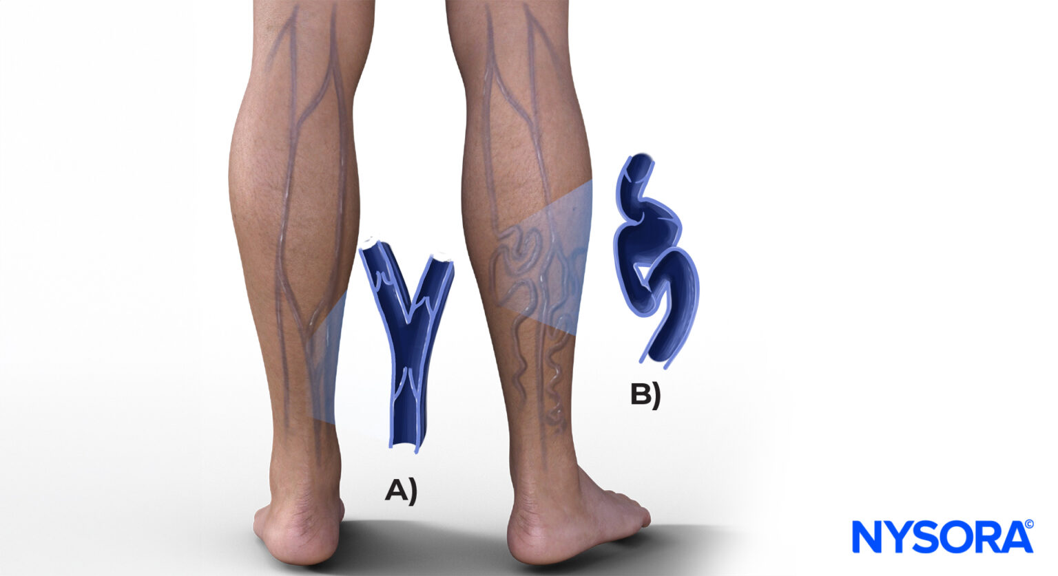 Mastering the maze: Expert tips for cannulating tortuous veins - NYSORA