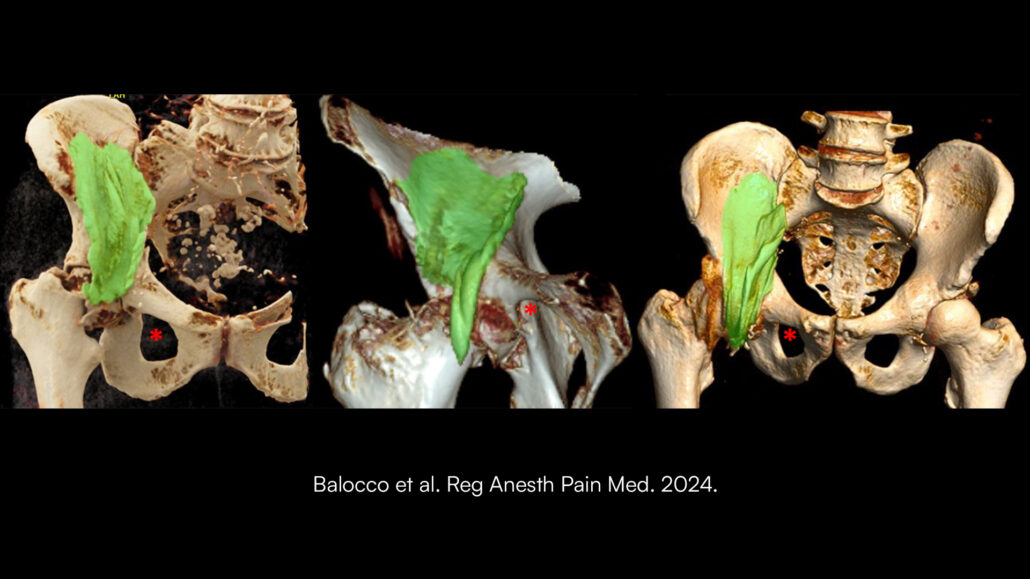 New Insights into PENG Block: 3D CT Scan Study on Injectate Spread - NYSORA