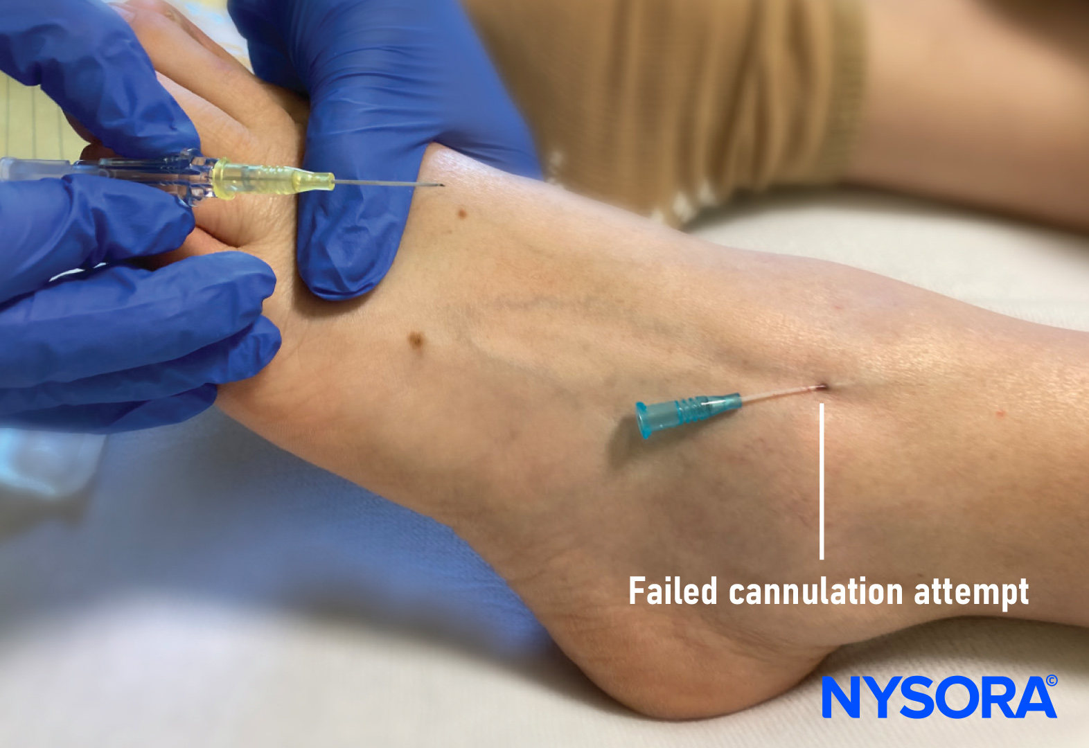 Mastering IV procedures: Strategies to reduce hematoma risk - NYSORA
