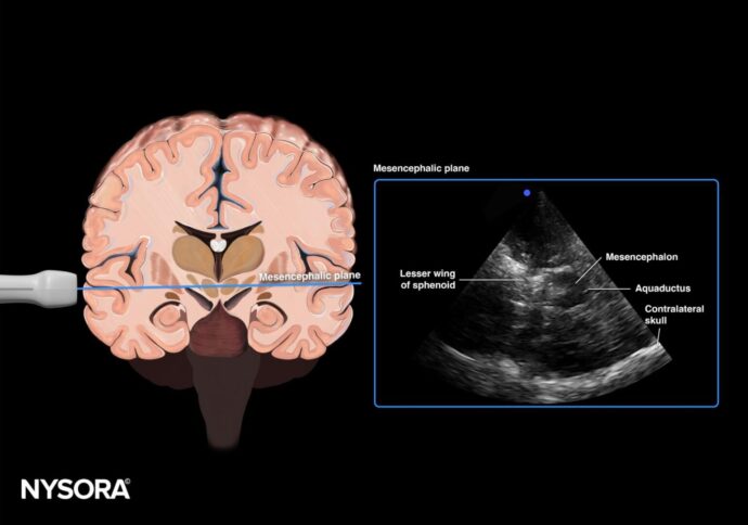 Case study: Detecting intracranial hypertension using transcranial ...