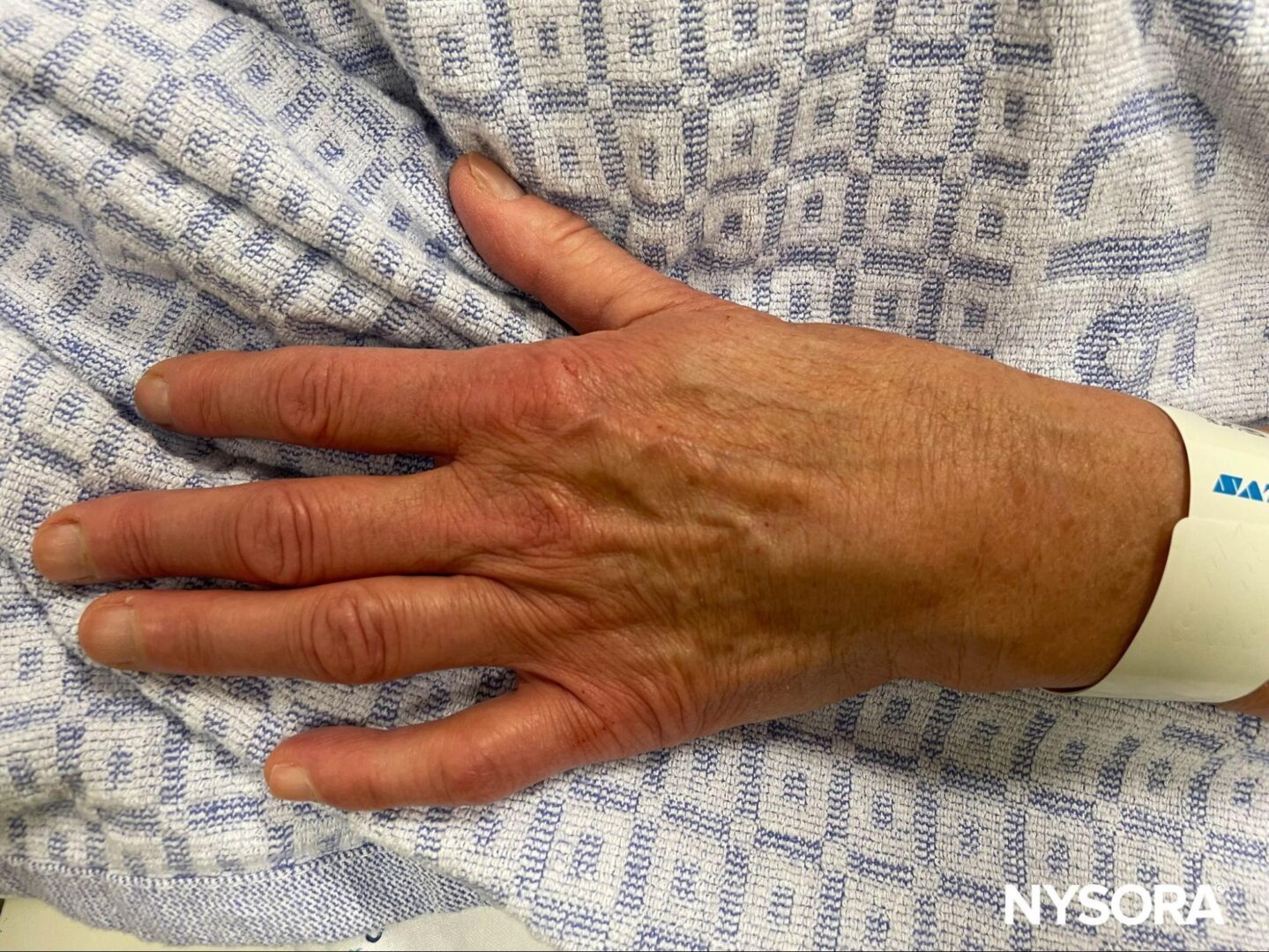 Mastering IV procedures: Strategies to reduce hematoma risk - NYSORA