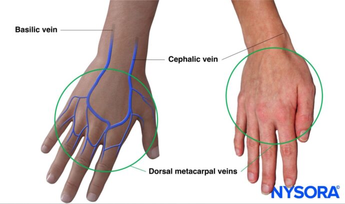 Finding the perfect vein: Tips for selecting the ideal site for IV ...