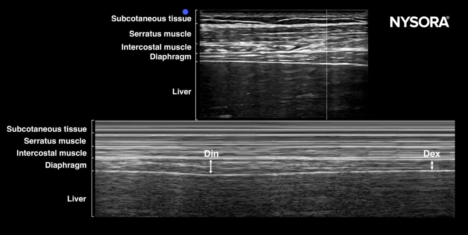 Case study: Assessing diaphragmatic function using ultrasound - NYSORA