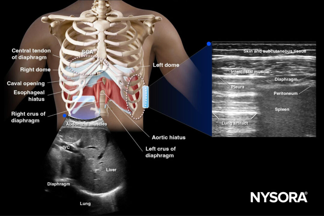 Case study: Assessing diaphragmatic function using ultrasound - NYSORA
