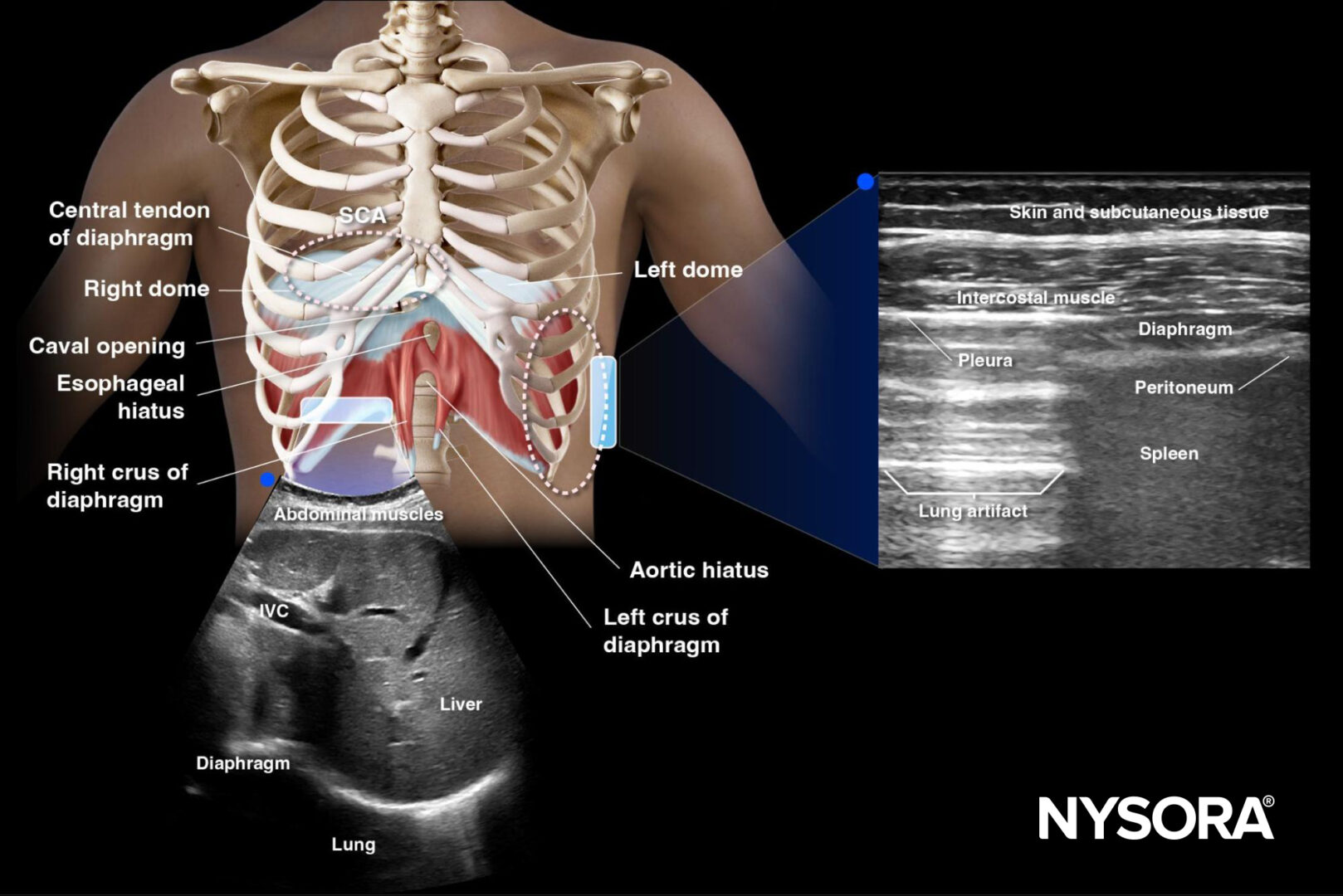 Case study: Assessing diaphragmatic function using ultrasound - NYSORA