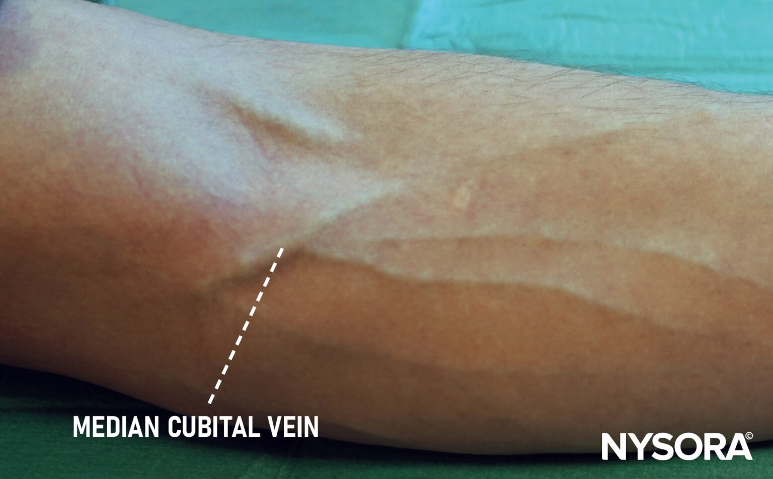 Finding the perfect vein: Tips for selecting the ideal site for IV ...