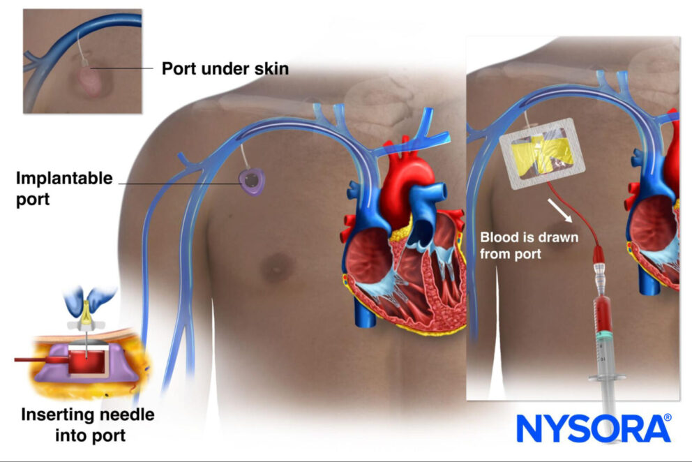 Understanding long-term intravenous devices - NYSORA