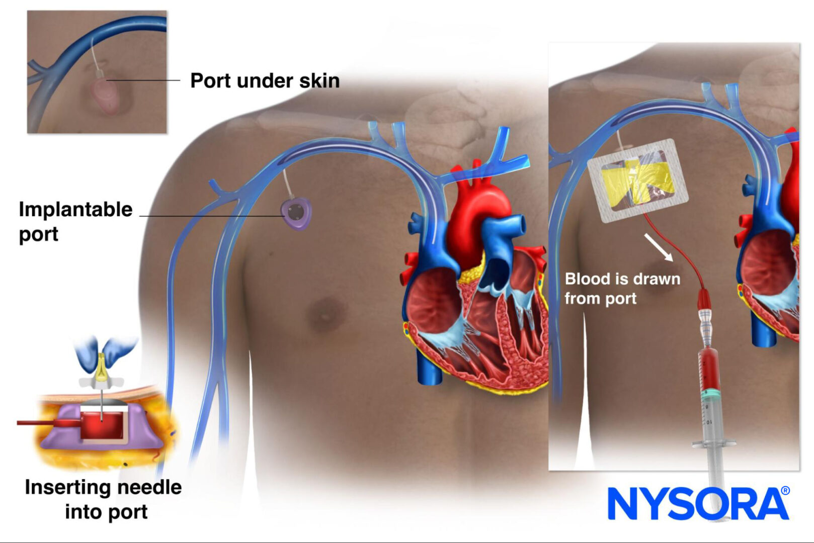 Understanding long-term intravenous devices - NYSORA