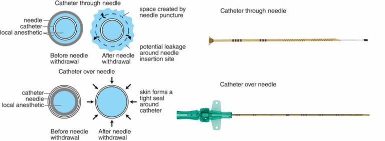 Understanding perineural catheter designs: Which one is right for your ...