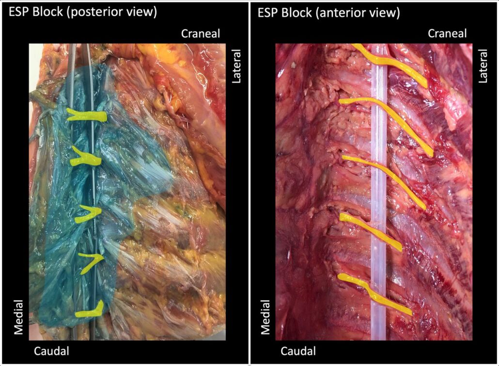 Understanding the local anesthetic spread in paraspinal blocks: A ...