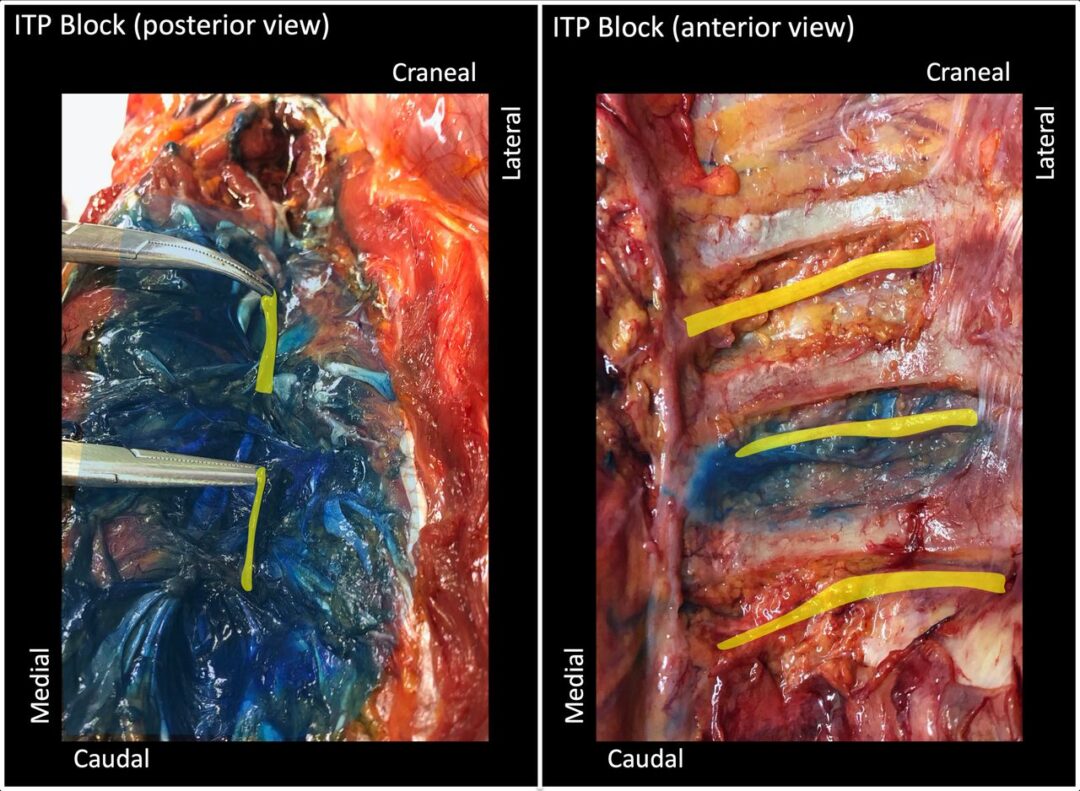 Understanding the local anesthetic spread in paraspinal blocks: A ...