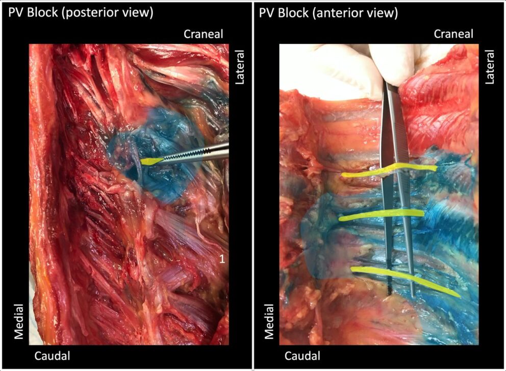 Understanding the local anesthetic spread in paraspinal blocks: A ...