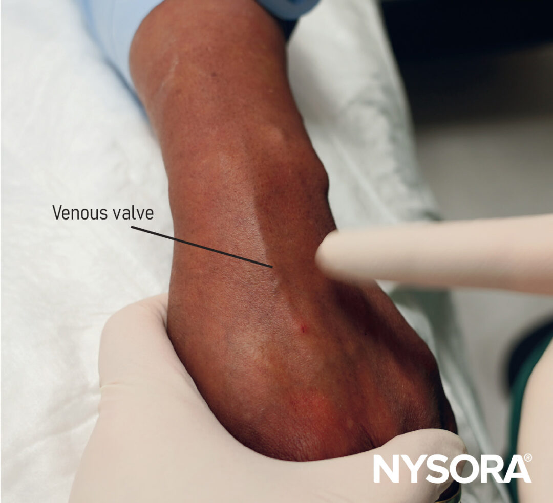 Avoiding vein cannulation at valves - NYSORA