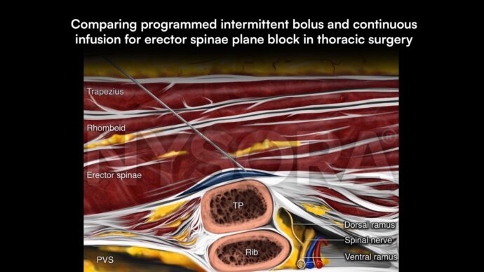Fascial plane blocks: Understanding their microanatomy and clinical ...