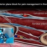 Popliteal Sciatic Nerve Block - Landmarks and Nerve Stimulator ...