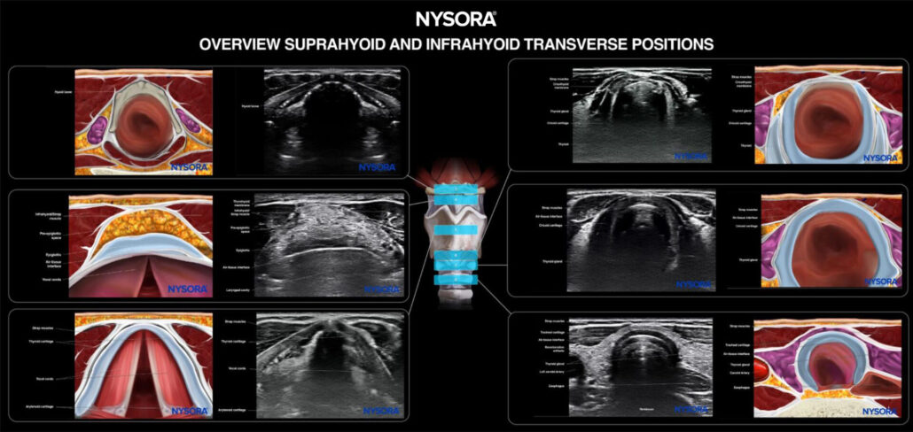 New POCUS Course: Airway Assessment! - NYSORA