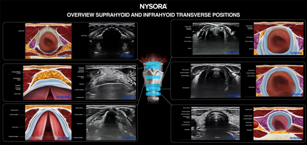 Nuevo curso POCUS: ¡Evaluación de la vía aérea! - NYSORA