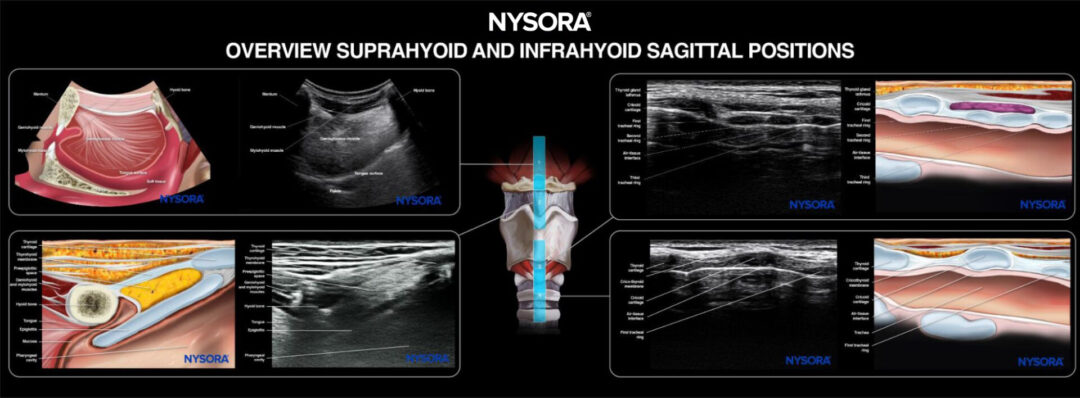 New POCUS Course: Airway Assessment! - NYSORA