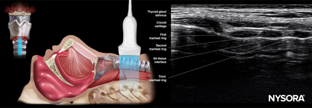 New POCUS Course: Airway Assessment! - NYSORA