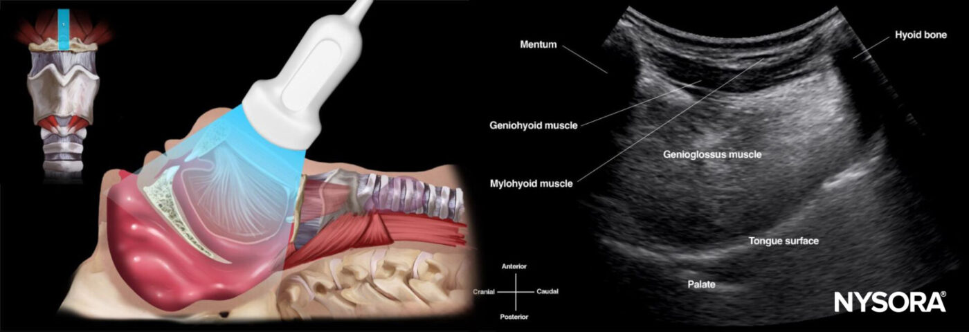 New POCUS Course: Airway Assessment! - NYSORA