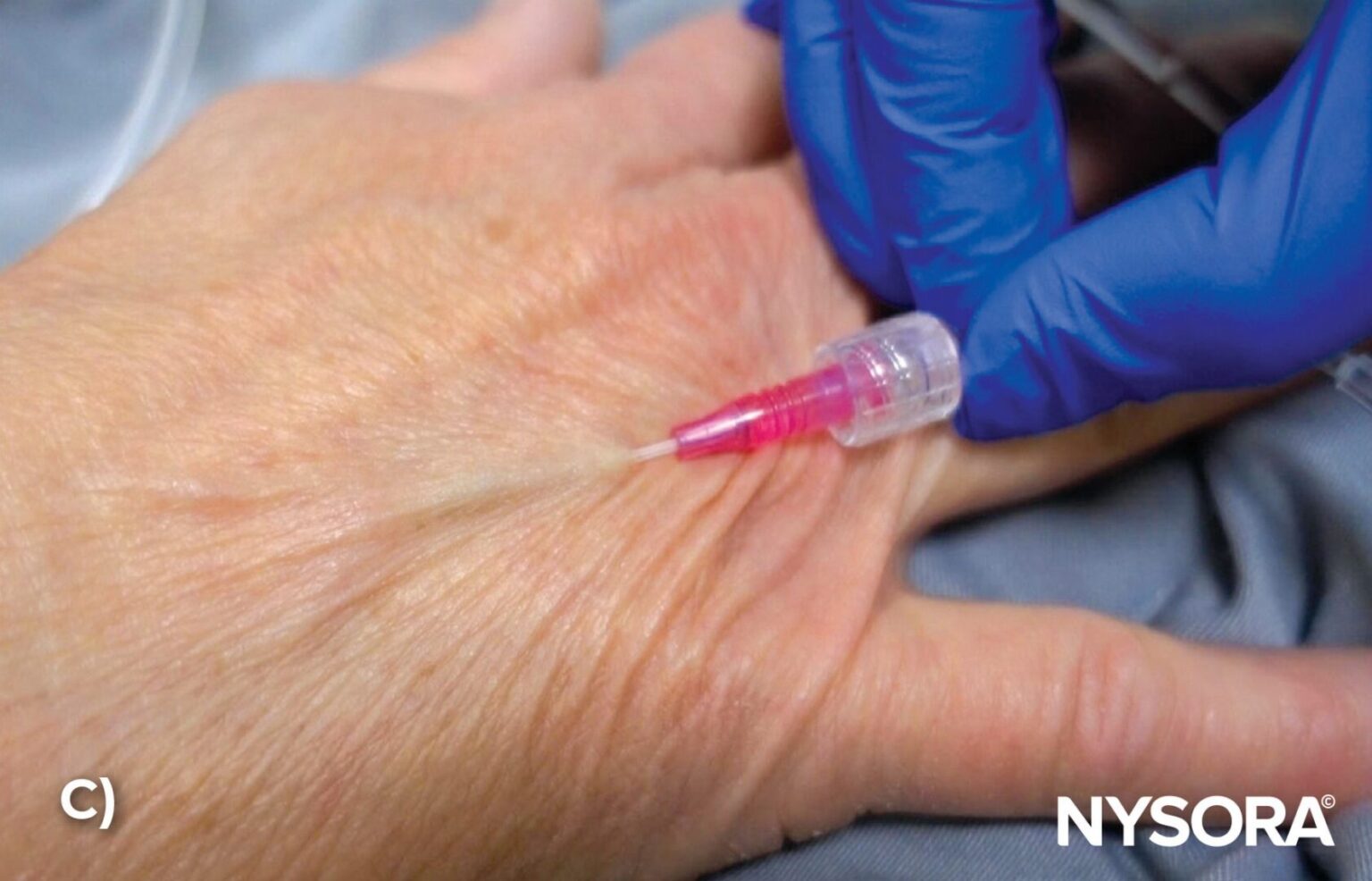 No IV fluid flow - NYSORA