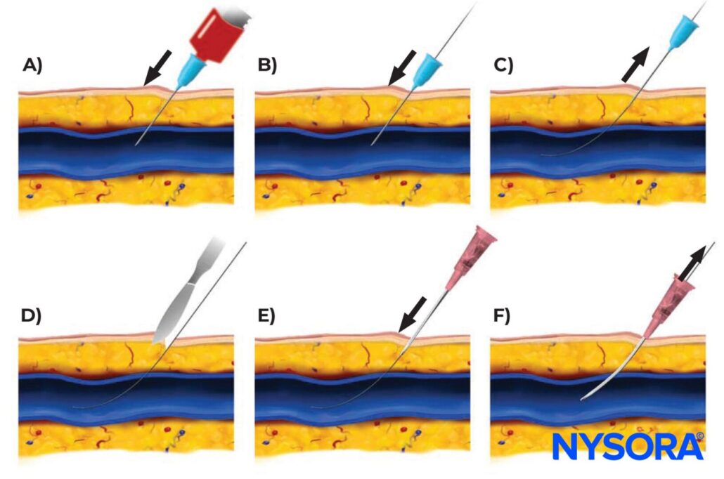 Large vein cannulation - NYSORA