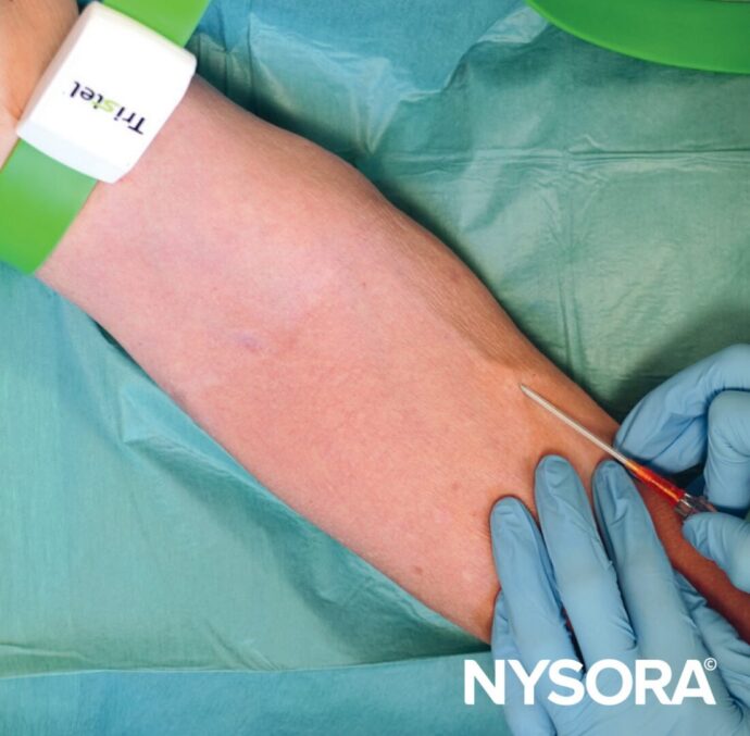 Large vein cannulation - NYSORA