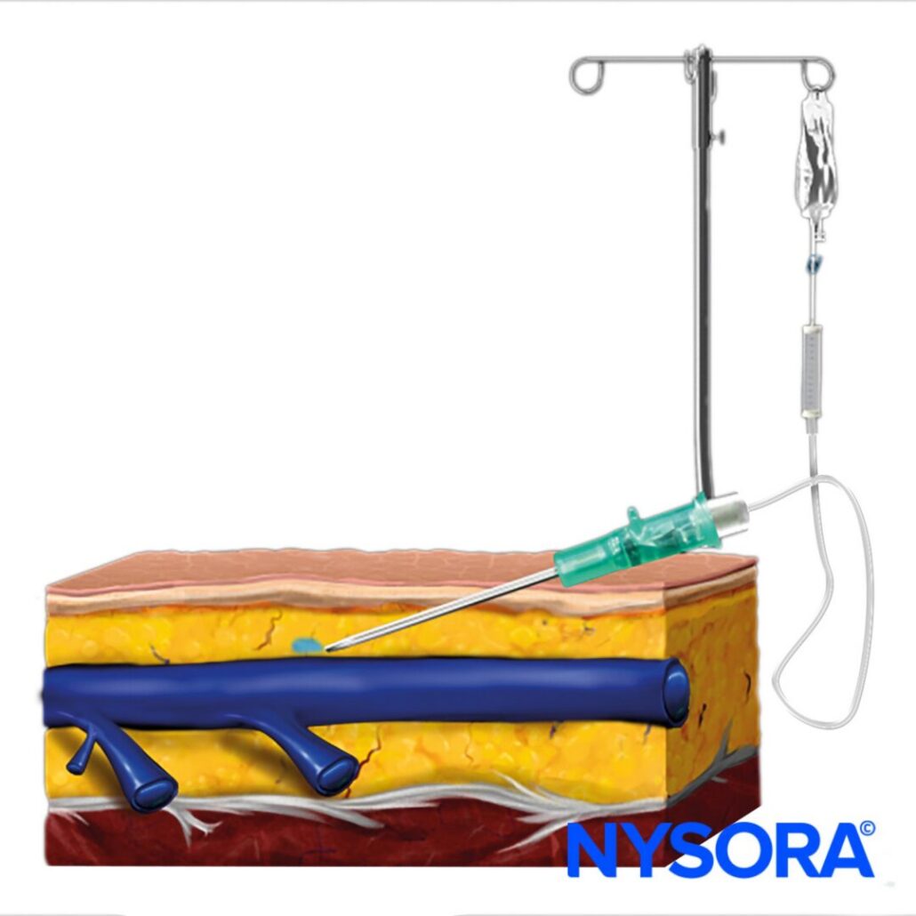 Common mistakes - NYSORA