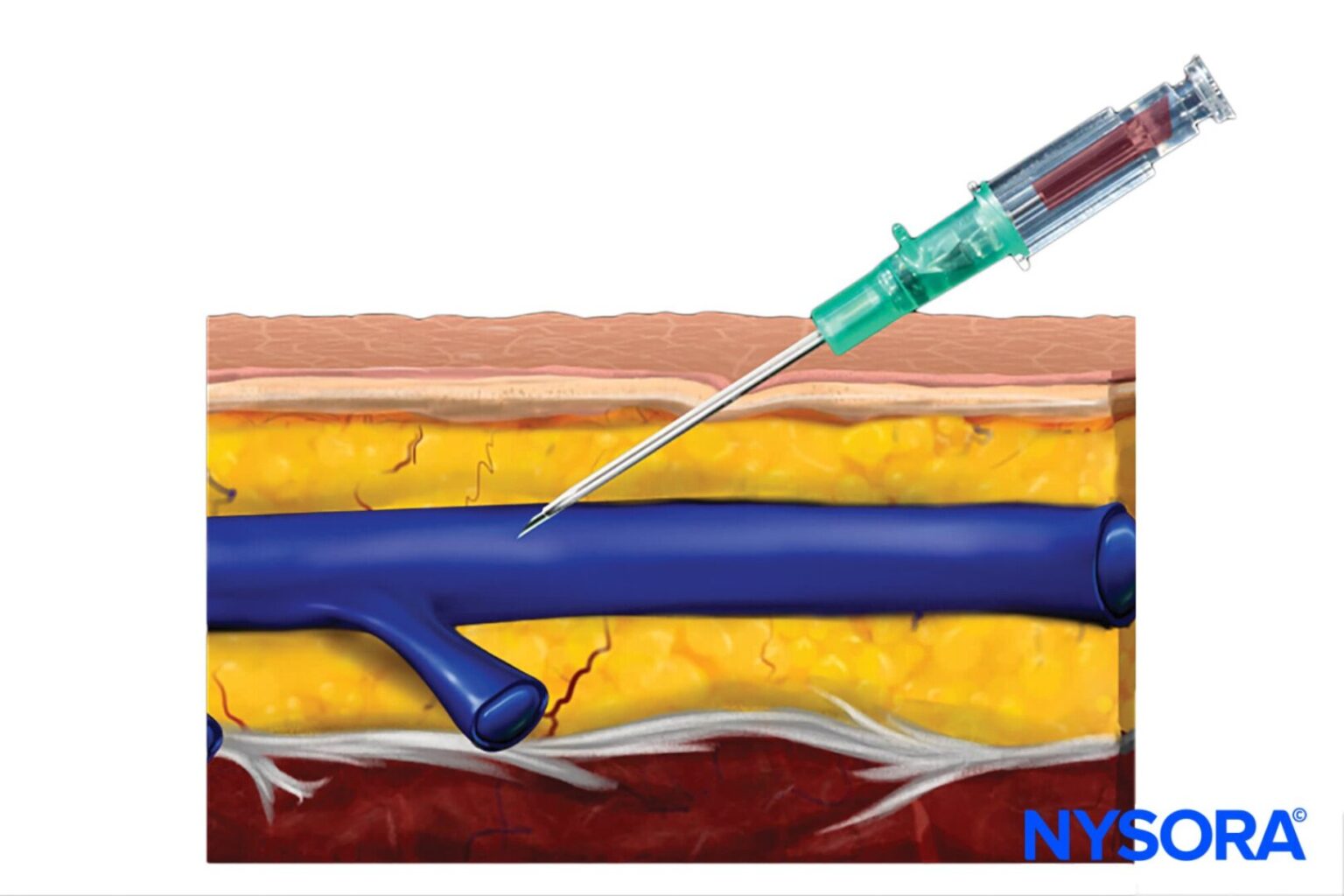 Common mistakes - NYSORA