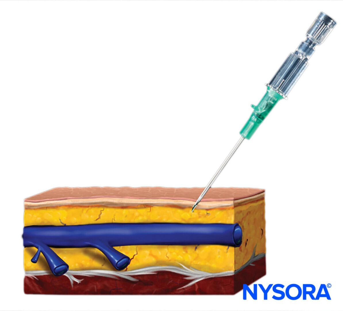 Common mistakes - NYSORA