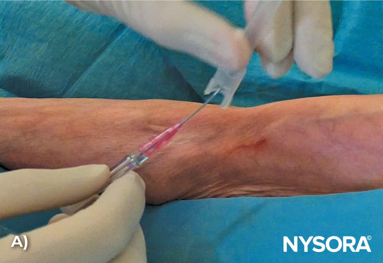 Cannulating complex veins - NYSORA