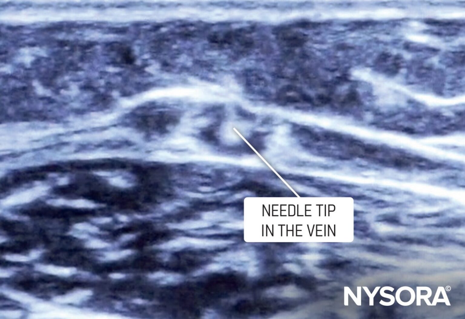 Cannulating complex veins - NYSORA