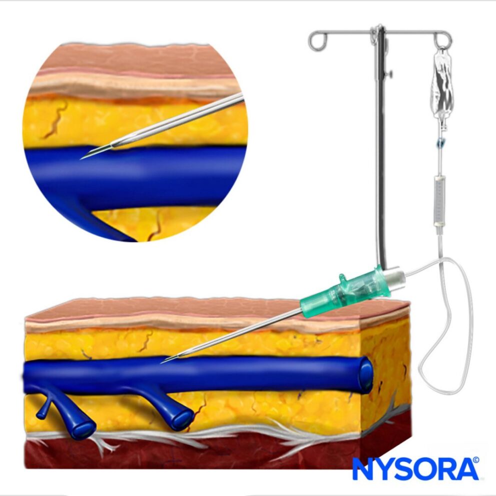 Failed cannulation - NYSORA